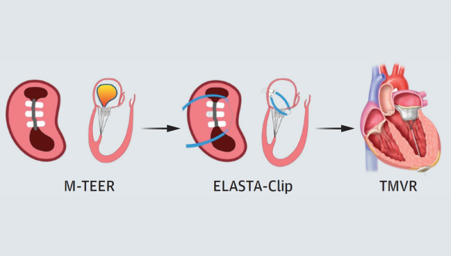 ELASTA-Clip Plus TMVR Safe, Feasible for Failed M-TEER | tctmd.com